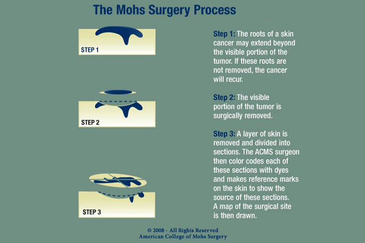 Mohs Surgery in Arlington, Memphis, Olive Branch | Advanced Dermatology ...