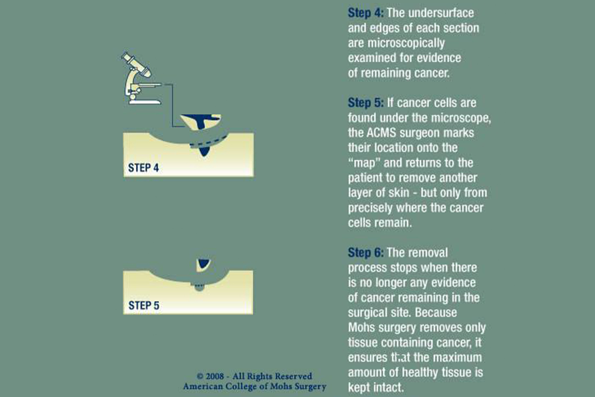 Mohs Surgery in Arlington, Memphis, Olive Branch | Advanced Dermatology ...